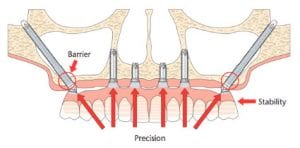 Zygomatic Implants - graftless surgery - Valley Oral Surgery